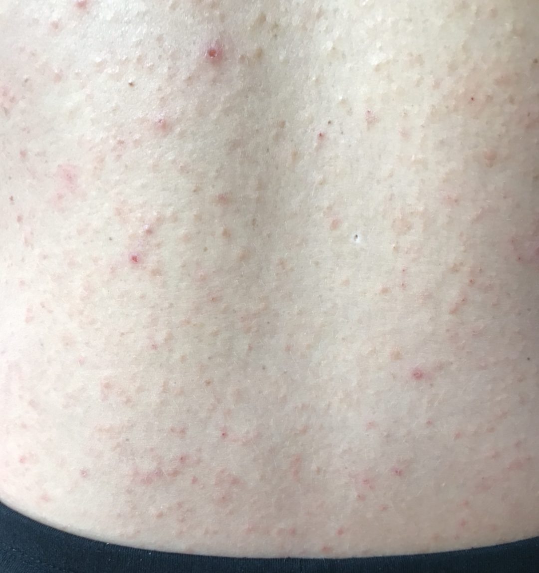 My Personal Story Of Allergic Contact Dermatitis – Diagnosis And ...